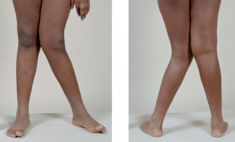 Varus vs Valgus Knee - Acadanow