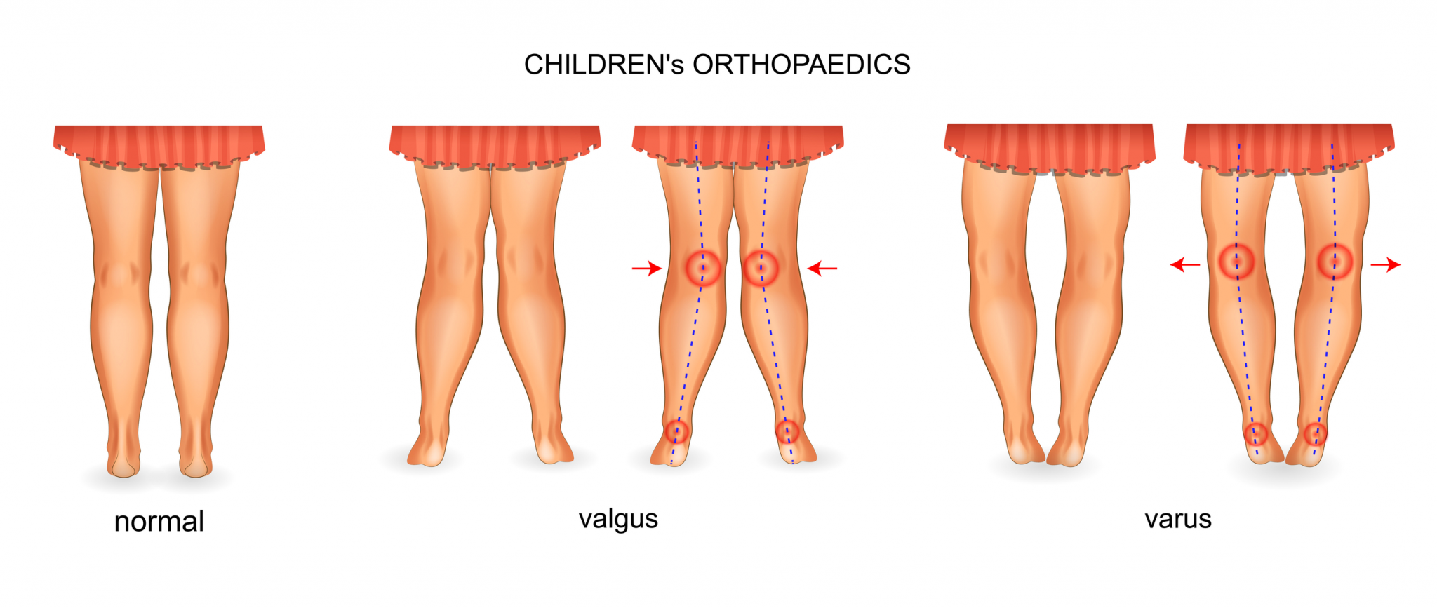 Varus vs Valgus Knee - Acadanow