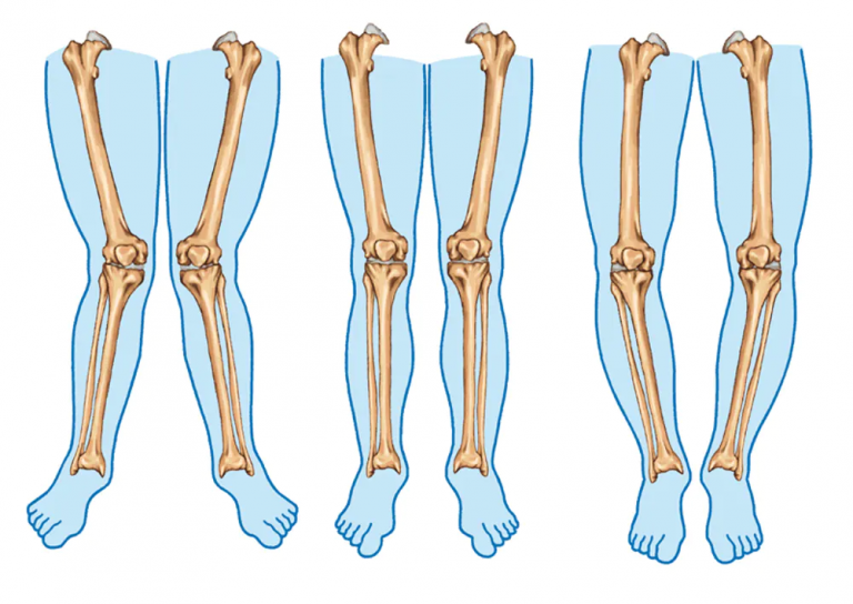 Varus vs Valgus Knee - Acadanow